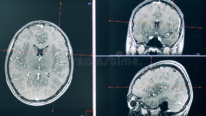 CT Scan of Human Brain in Dynamic Stock Video - Video of checkup ...
