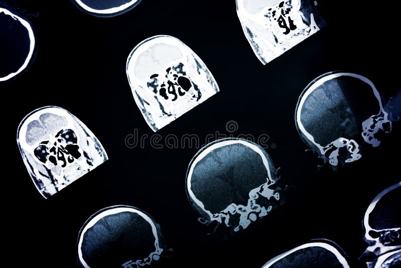 CT scan of the head stock photo. Image of hand, cancer - 30878290