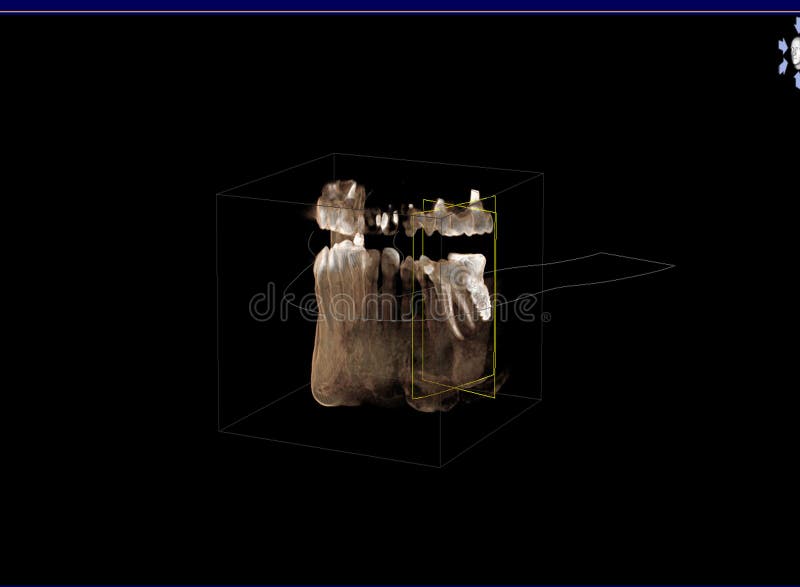 CT Scan of the Jaw with Dental Pin and Missing Tooth in Four Planes ...