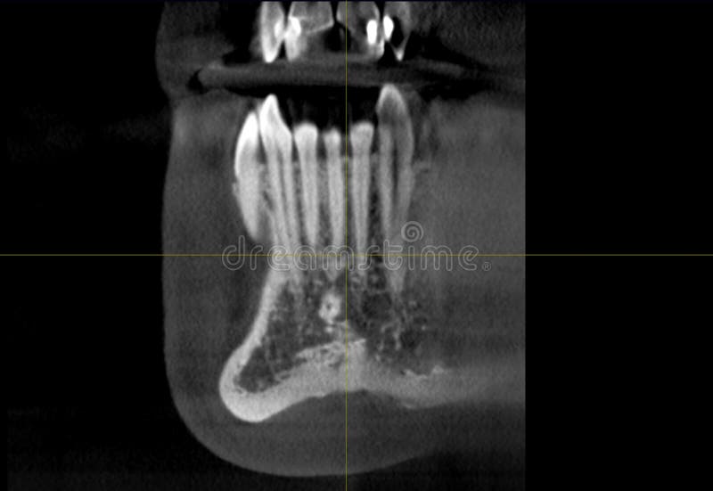 CT Scan of the Jaw with Dental Pin and Missing Tooth in Four Planes ...