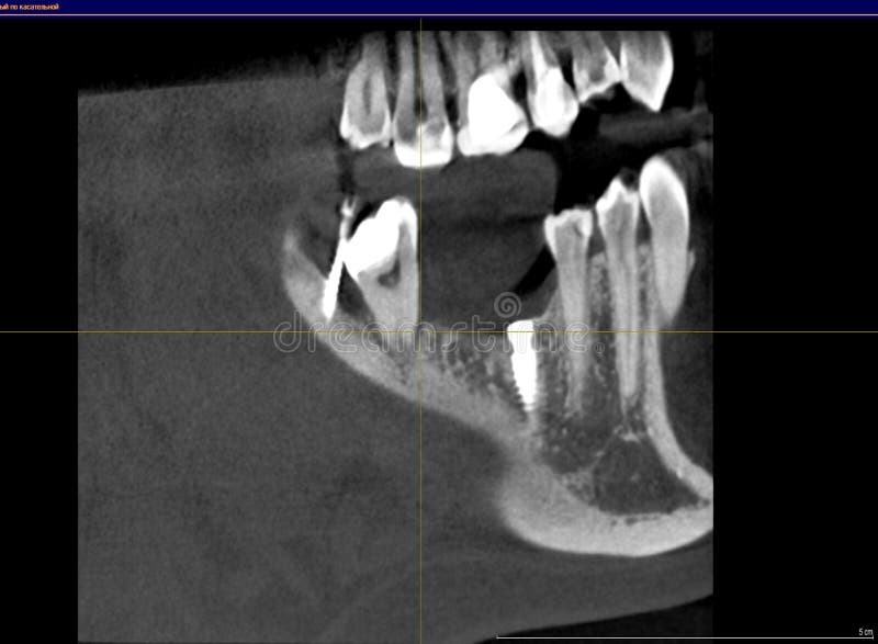 CT Scan of the Jaw with Dental Pin and Missing Tooth in Four Planes ...