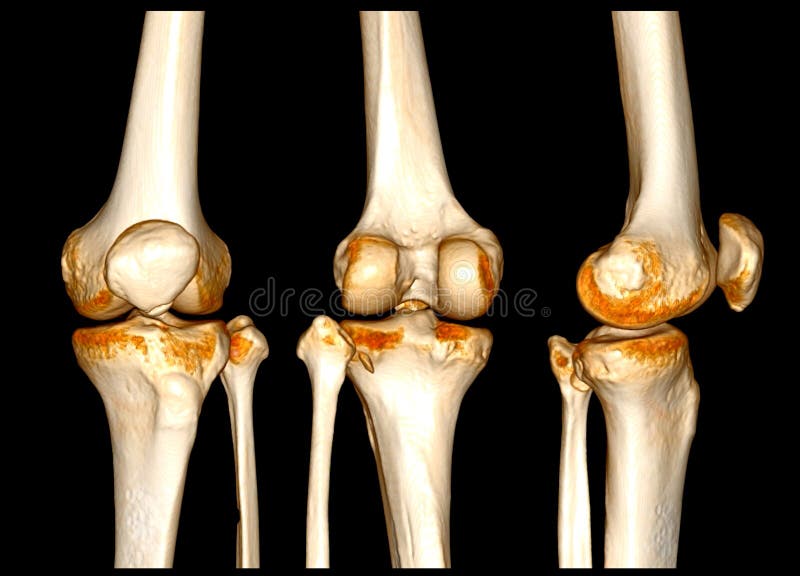 CT Scan of Knee Joint Sagittal and Coronal in Case Fracture Patella ...