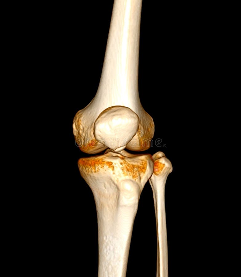 CT Scan of Lower Extremity ,3D Illustration of Femur Bone , Knee Joint ...