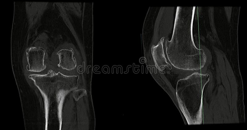 MRI Knee Joint or Magnetic Resonance Imaging Compare Axial, Coronal and ...