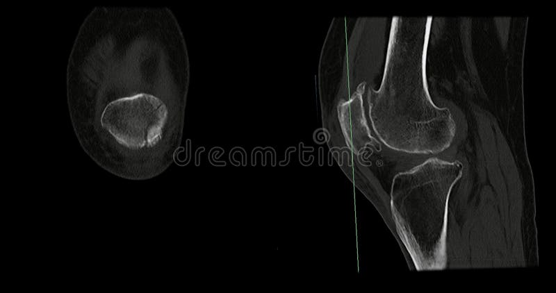 CT Scan of Knee Joint Sagittal and Coronal in Case Fracture Patella ...
