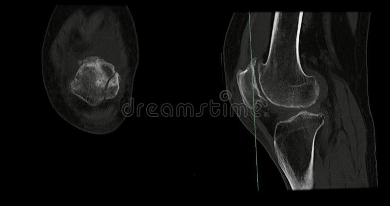 CT Scan of Knee Joint Sagittal and Coronal in Case Fracture Patella ...