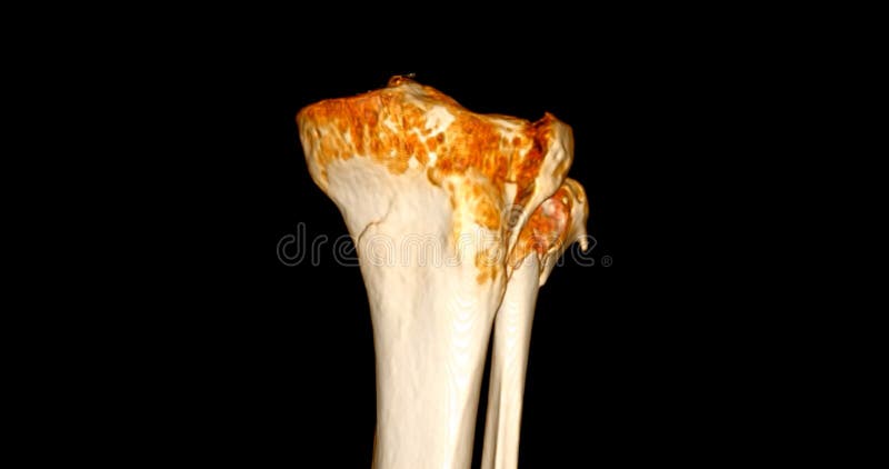 Fracture of the Tibia. Two Types of Fracture Stock Illustration ... Fracture of the Tibia. Two Types of Fracture Stock Illustration ...