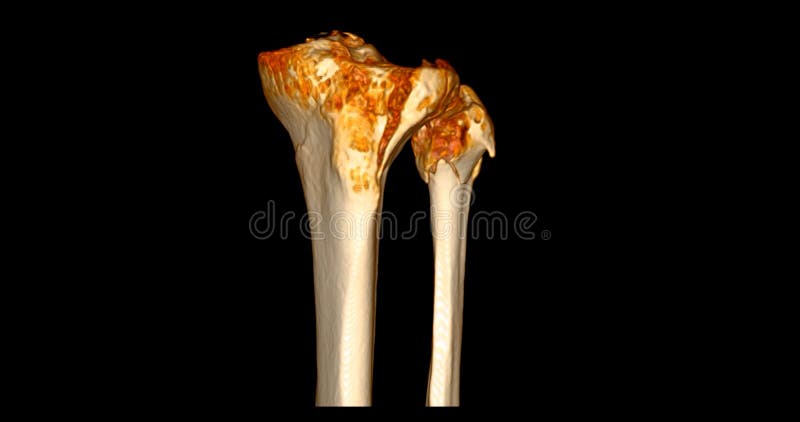 Fracture of the Tibia. Two Types of Fracture Stock Illustration ... Fracture of the Tibia. Two Types of Fracture Stock Illustration ...