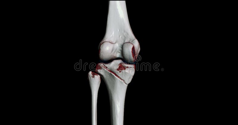 Fracture of the Tibia. Two Types of Fracture Stock Illustration ... Fracture of the Tibia. Two Types of Fracture Stock Illustration ...