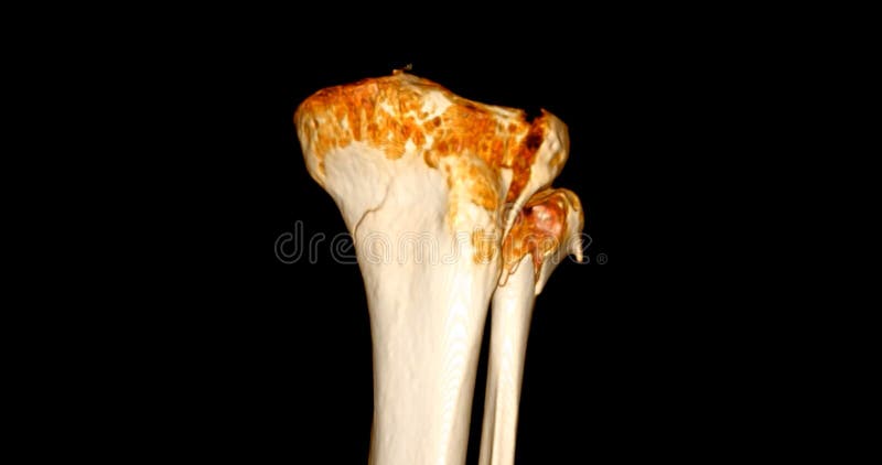Fracture of the Tibia. Two Types of Fracture Stock Illustration ... Fracture of the Tibia. Two Types of Fracture Stock Illustration ...