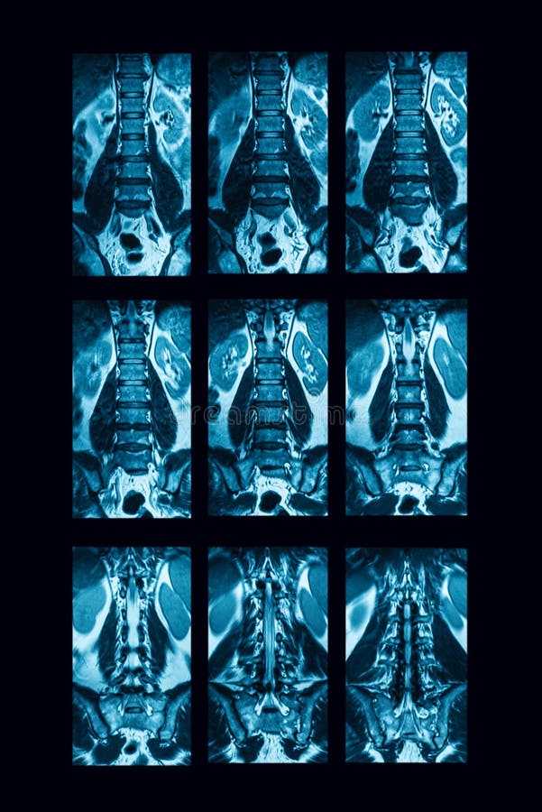 CT-scan of Lumbar Spine, Case of Lumbar Spondylosis Stock Image - Image ...