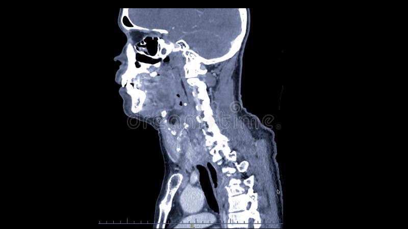 A CT Scan of the Neck Sagittal View for Diagnostic Technique is ...
