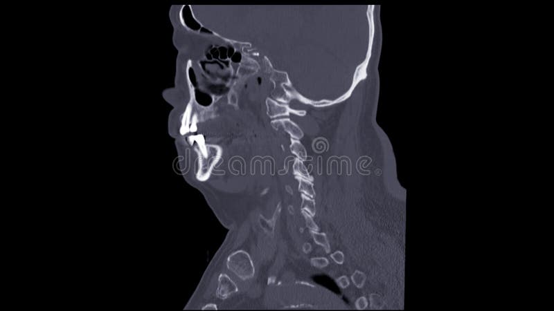 A CT Scan of the Neck Sagittal View for Diagnostic Technique is ...
