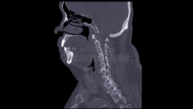 A CT Scan of the Neck Sagittal View for Diagnostic Technique is ...