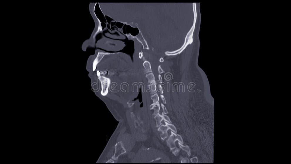 A CT Scan of the Neck Sagittal View for Diagnostic Technique is ...