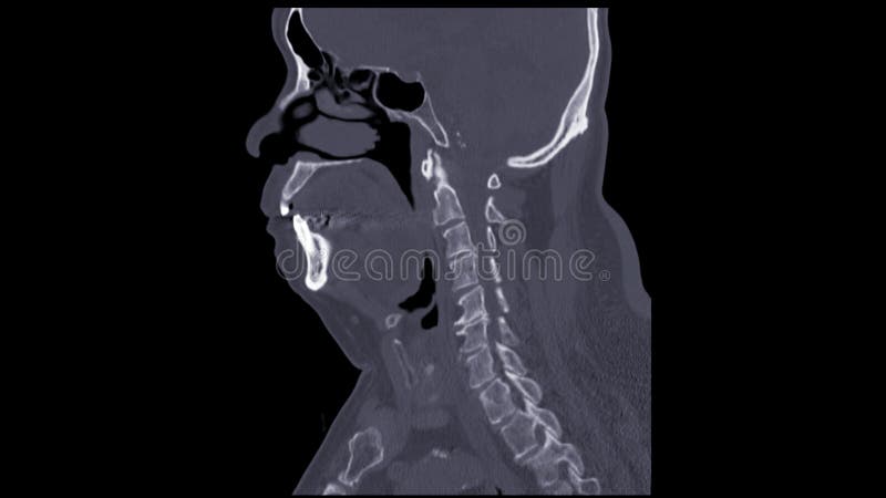 A CT Scan of the Neck Sagittal View for Diagnostic Technique is ...