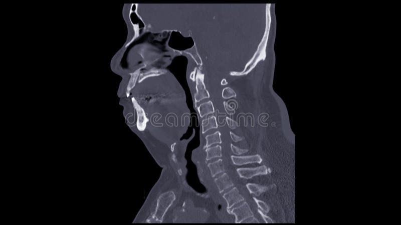 A CT Scan of the Neck Sagittal View for Diagnostic Technique is ...
