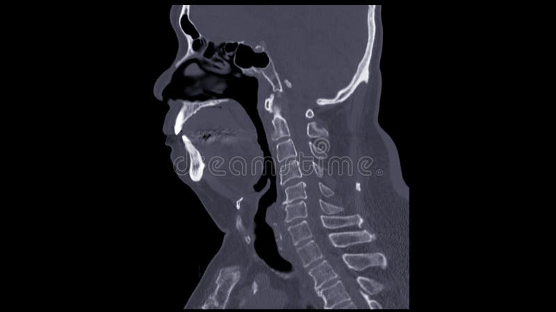 A CT Scan of the Neck Sagittal View for Diagnostic Technique is ...