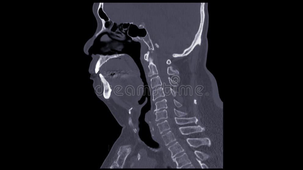 A CT Scan of the Neck Sagittal View for Diagnostic Technique is ...