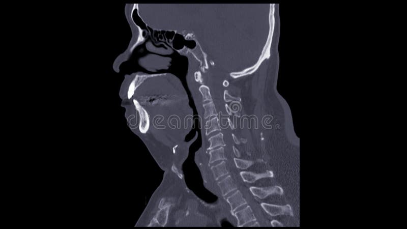 A CT Scan of the Neck Sagittal View for Diagnostic Technique is ...