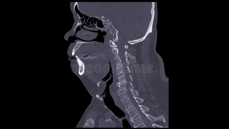 A CT Scan of the Neck Sagittal View for Diagnostic Technique is ...