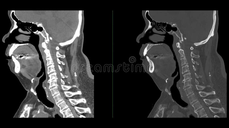 A CT Scan of the Neck Sagittal View for Diagnostic Technique is ...