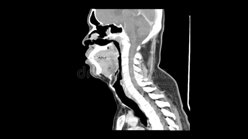Ct Scan of Neck Side View Smooth Motion Stock Footage - Video of ...