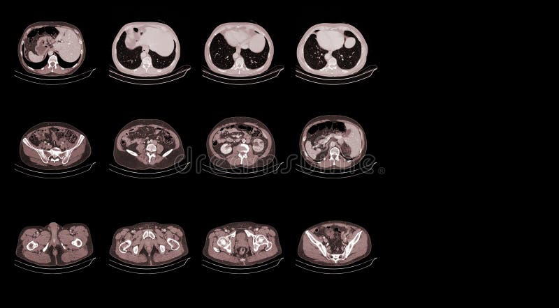 CT Abdomen stock image. Image of human, design, health - 16474231