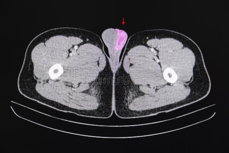 A CT Scan of a Patient with Testicular Cancer Stock Image - Image of ...