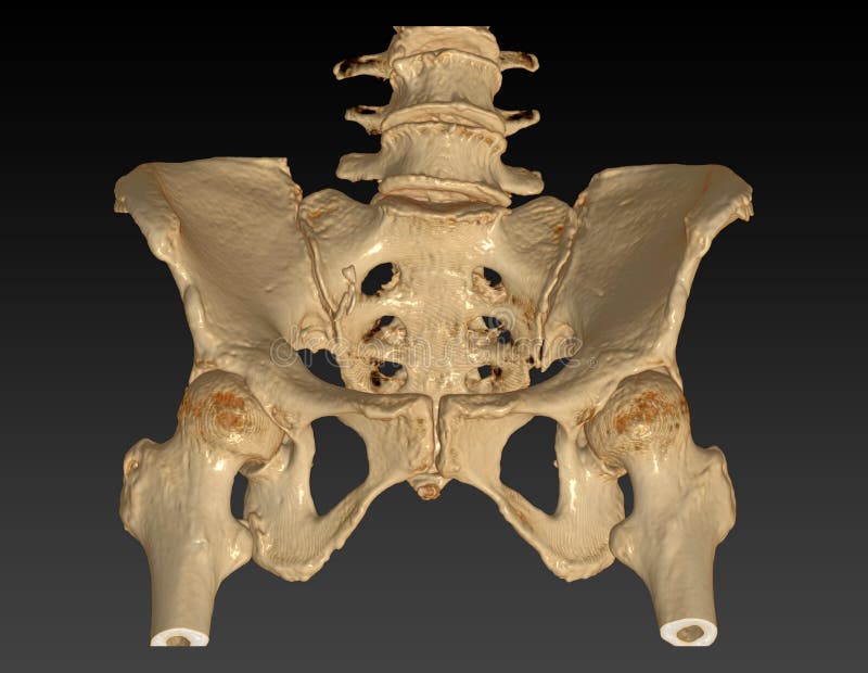 CT Scan of Pelvic Bone with Both Hip Joint 3D Rendering Image Inlet and ... CT Scan of Pelvic Bone with Both Hip Joint 3D Rendering Image Inlet and ...