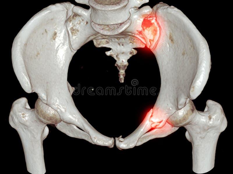 CT Scan Pelvic Bone with Both Hip Joint 3D Rendering Showign Fracture ... CT Scan Pelvic Bone with Both Hip Joint 3D Rendering Showign Fracture ...