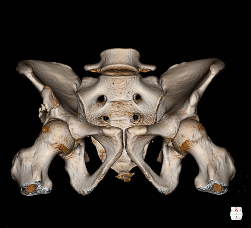 Ct Scan Of Pelvis