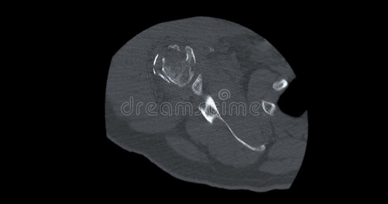 CT Scan of Shoulder Joint in Case Fracture Shoulder Joint Stock Image ...