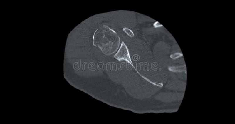 CT Scan of Shoulder Joint in Case Fracture Shoulder Joint Stock Photo ...