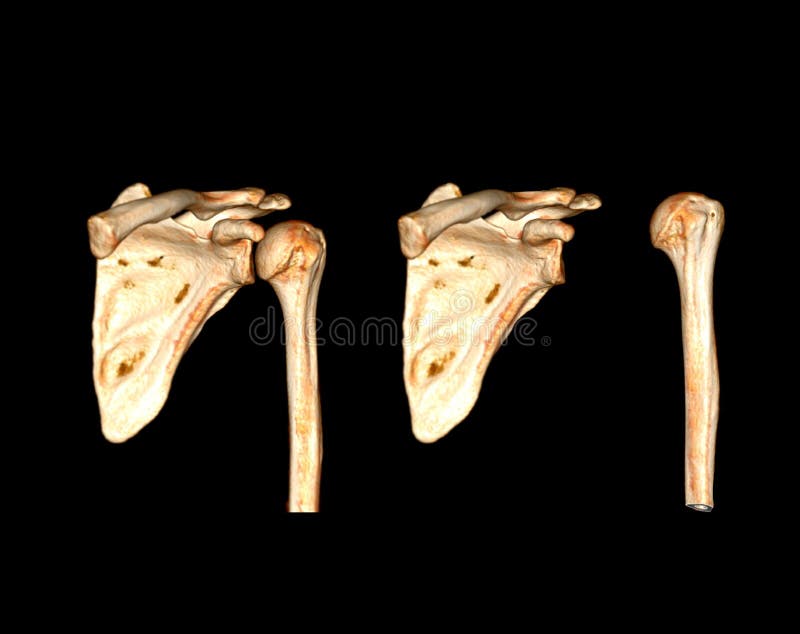 CT Scan of Shoulder Joint and Humerus Bone or Arm Stock Illustration ... CT Scan of Shoulder Joint and Humerus Bone or Arm Stock Illustration ...