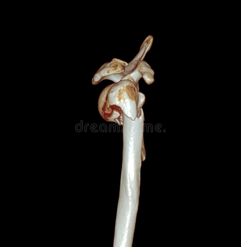 CT Scan of Shoulder Joint and Humerus Bone or Arm Stock Illustration ... CT Scan of Shoulder Joint and Humerus Bone or Arm Stock Illustration ...