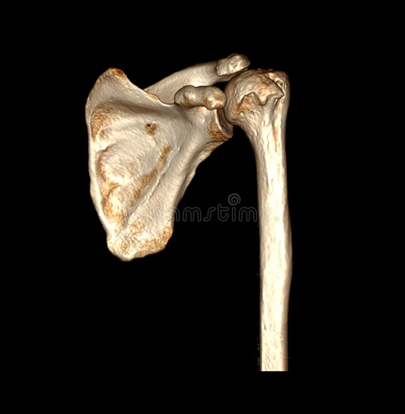 CT scan of shoulder joint stock illustration. Illustration of elbow ...