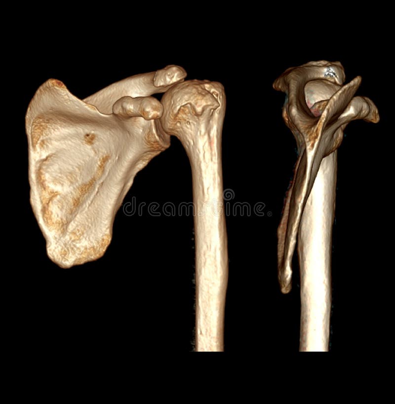 CT scan of shoulder joint stock illustration. Illustration of doctor ... CT scan of shoulder joint stock illustration. Illustration of doctor ...