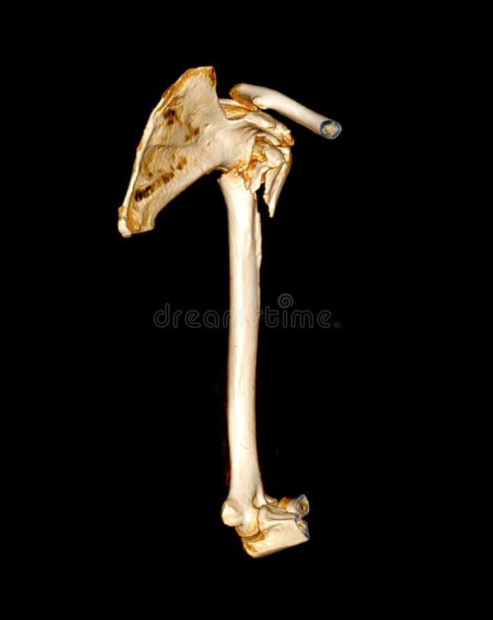 CT Scan of Shoulder Joint and Humerus Bone or Arm Stock Illustration ...