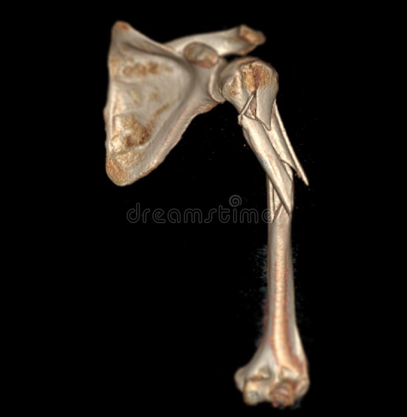 CT Scan of Shoulder Joint and Humerus Bone or Arm Stock Illustration ...