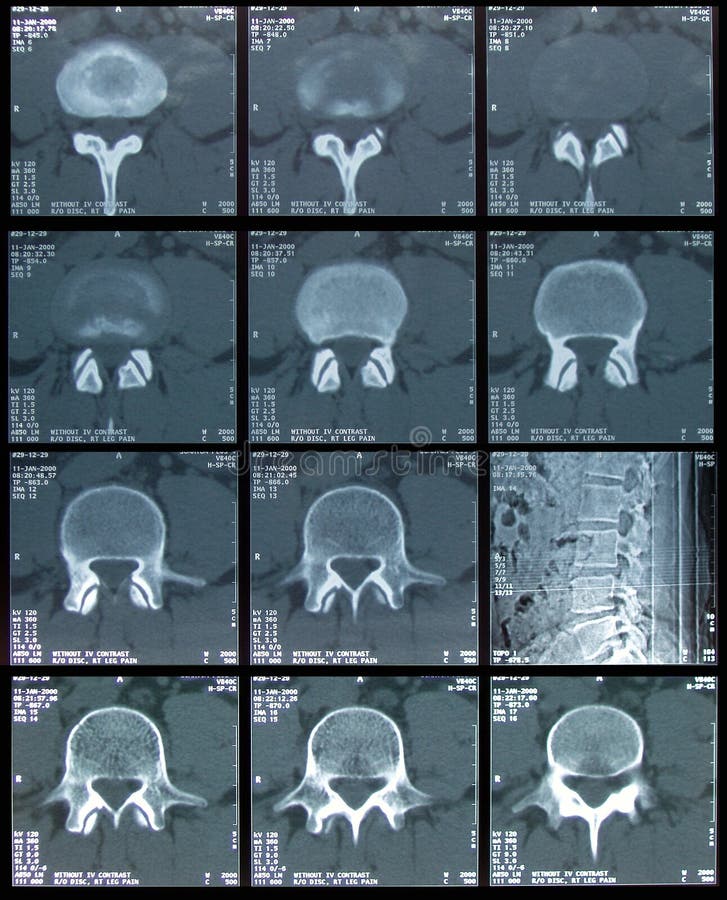 CT Scan of spine stock illustration. Illustration of disc - 63371