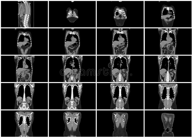 Ct Scan Step Set of Body Lung Sagittal View Stock Photo - Image of ...