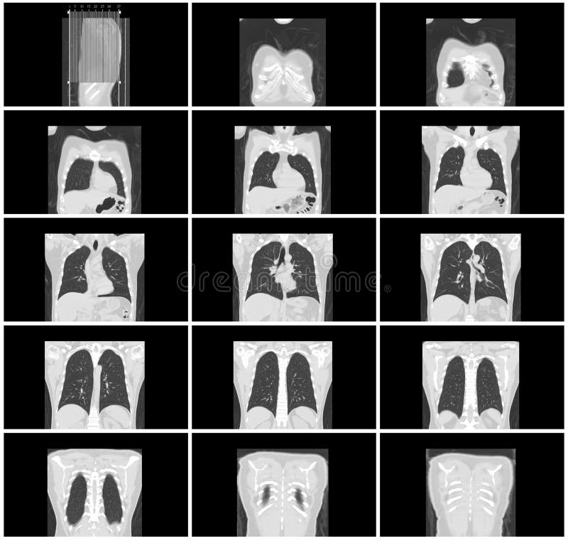 Ct Scan Step Set of Body Lung Coronal View Stock Image - Image of lung ...