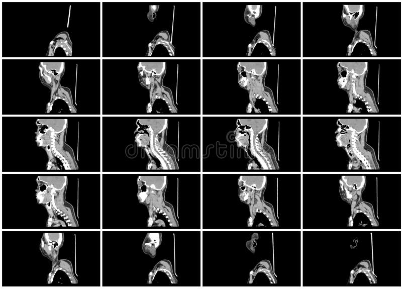 Ct Scan Step Set of Body Lung Sagittal View Stock Photo - Image of ...