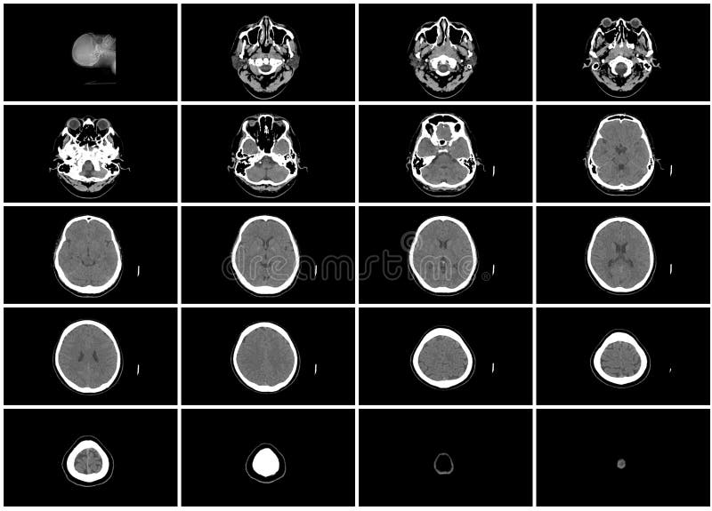 Ct Scan Step Set of Upper Brain Head Axial Top View Stock Image - Image ...