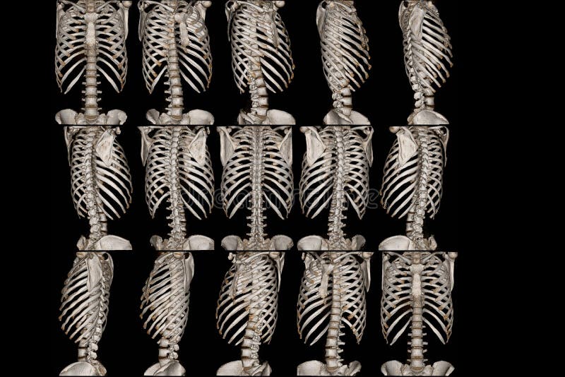 CT Scan Thoracic Spine 3D Image Case Trauma Fracture Thoracic Spine ... CT Scan Thoracic Spine 3D Image Case Trauma Fracture Thoracic Spine ...