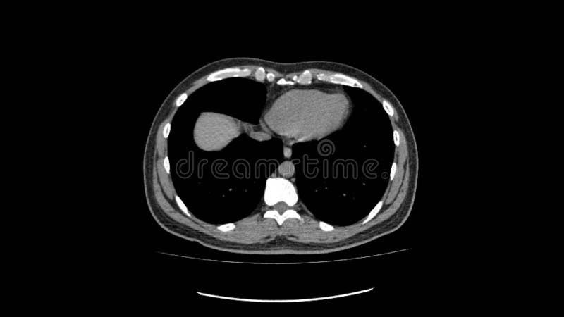 CT Scan of Upper Abdomen Comparison Coronal View Stock Footage - Video ...