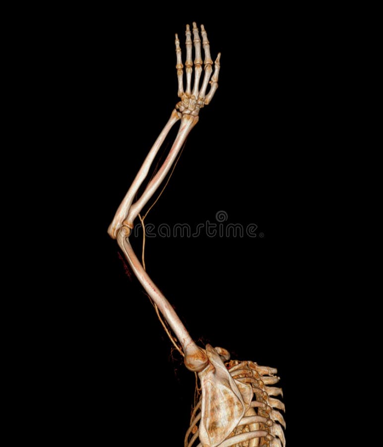CT Scan of Upper Extremity or the Arm 3d Rendering Image. Stock ...