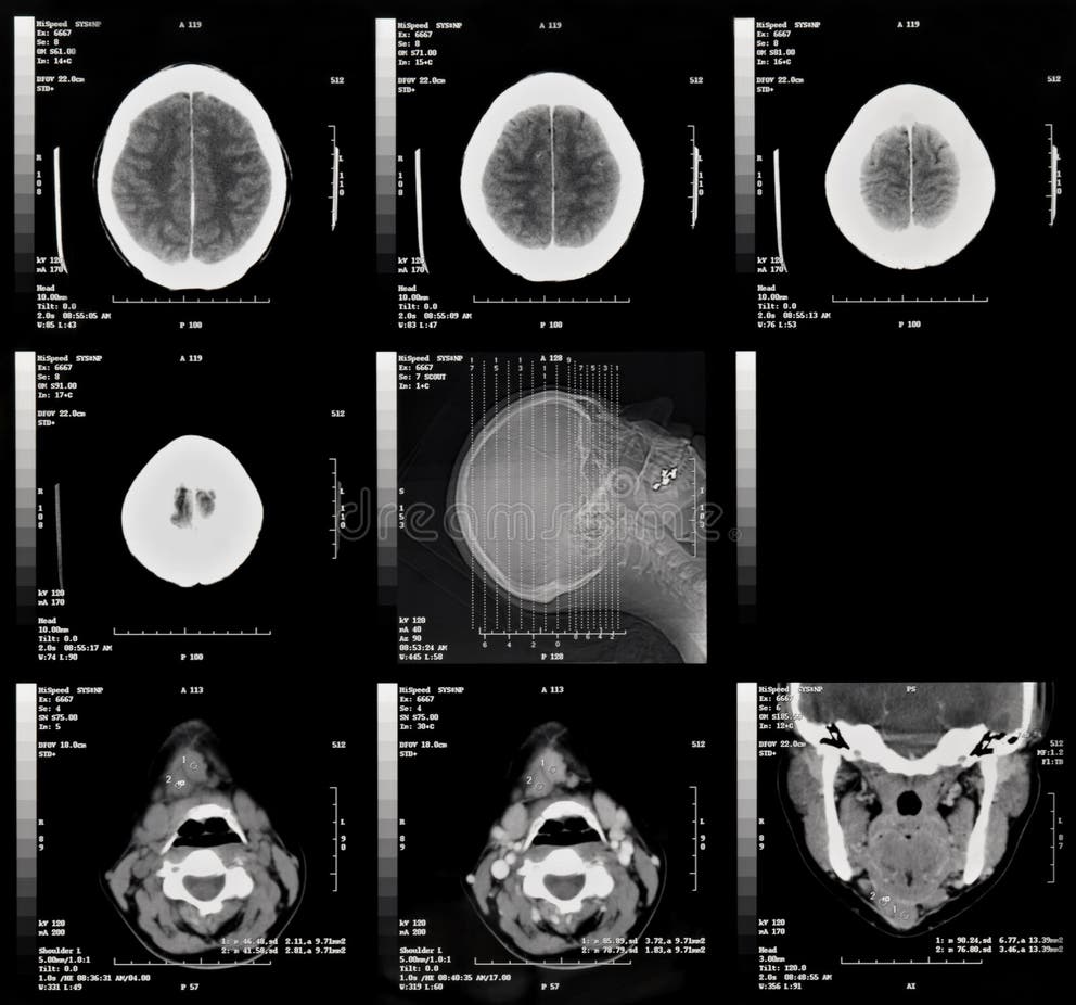 1,215 Ct Scan Brain Head Stock Photos - Free & Royalty-Free Stock ...