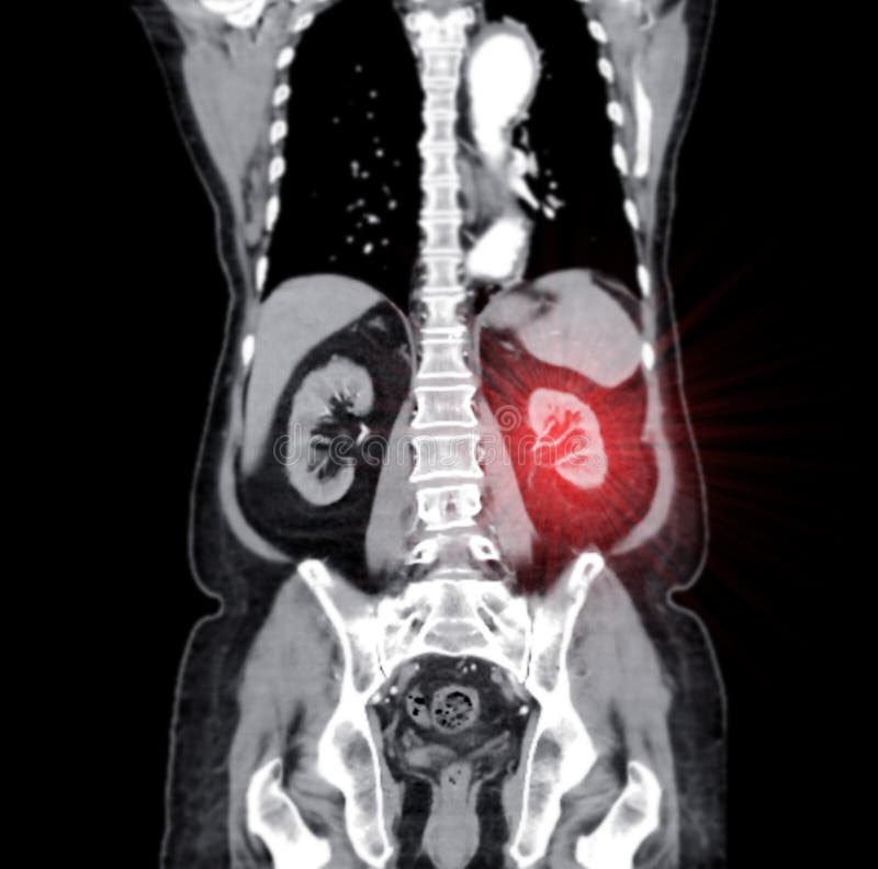 CT Scan of Whole Abdomen with Injection Contrast Media in Coronal View ...
